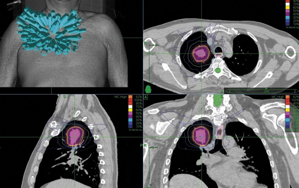 SBRT revolution in lung radiotherapy - Medical Forum