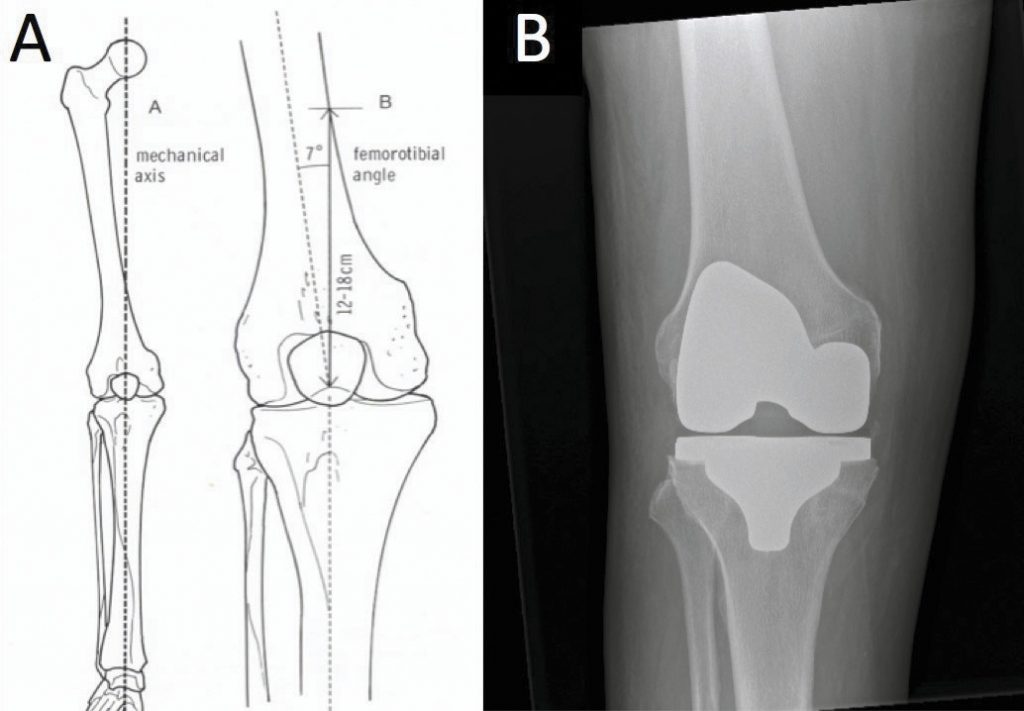 Computer navigation in Total Knee Replacement - Medical Forum