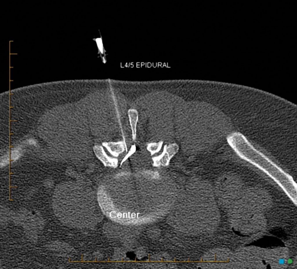 EPIDURAL-INJECTION-CT-0001_revised - Medical Forum