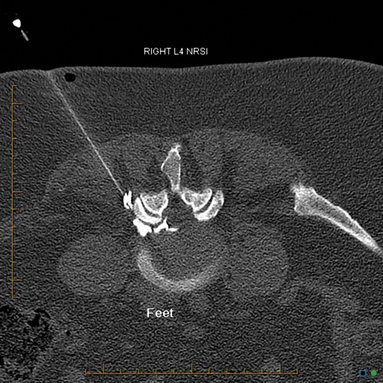 EPIDURAL-INJECTION-CT-0002-revised - Medical Forum