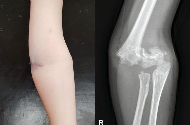 Paediatric elbow injuries - Medical Forum