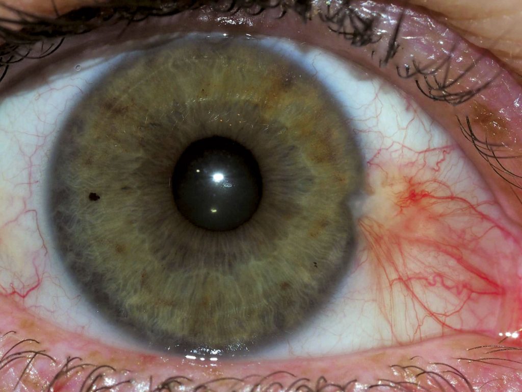 Pterygia – what action is required? - Medical Forum