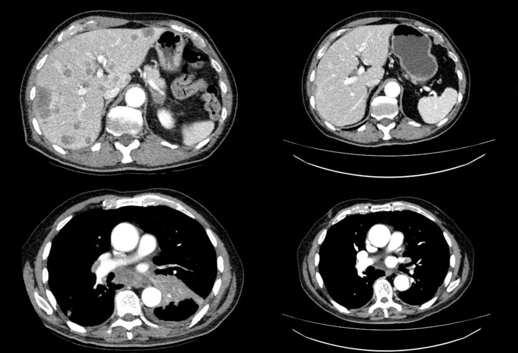 New approaches to metastatic lung cancer - Medical Forum