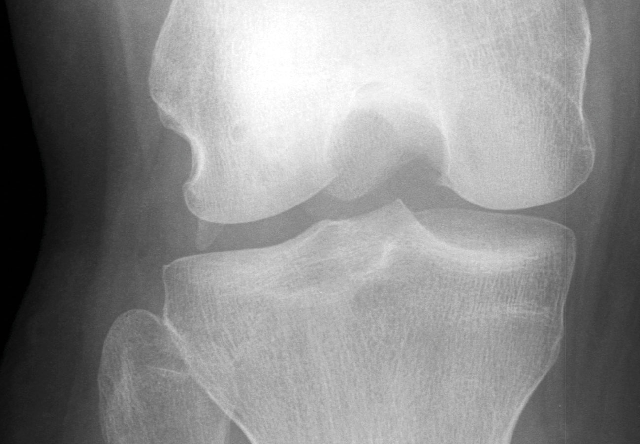 The fabella – it's role and problems - Medical Forum