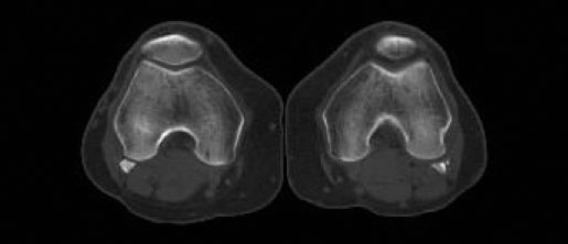 The fabella – it's role and problems - Medical Forum