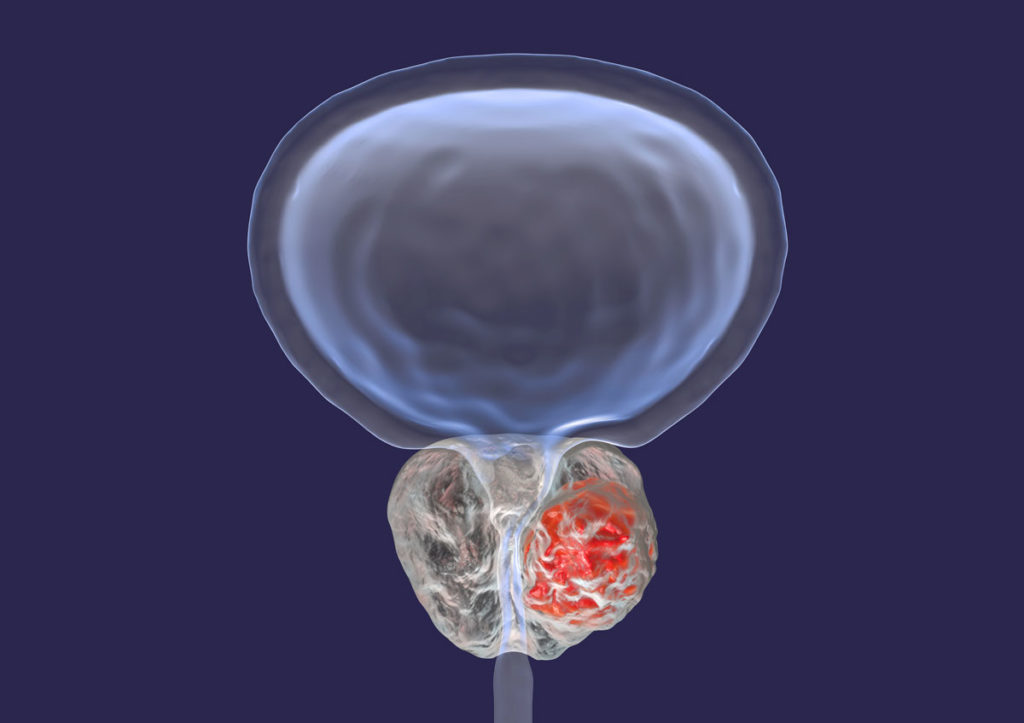 prostate-cancer-medical-forum-clincial - Medical Forum