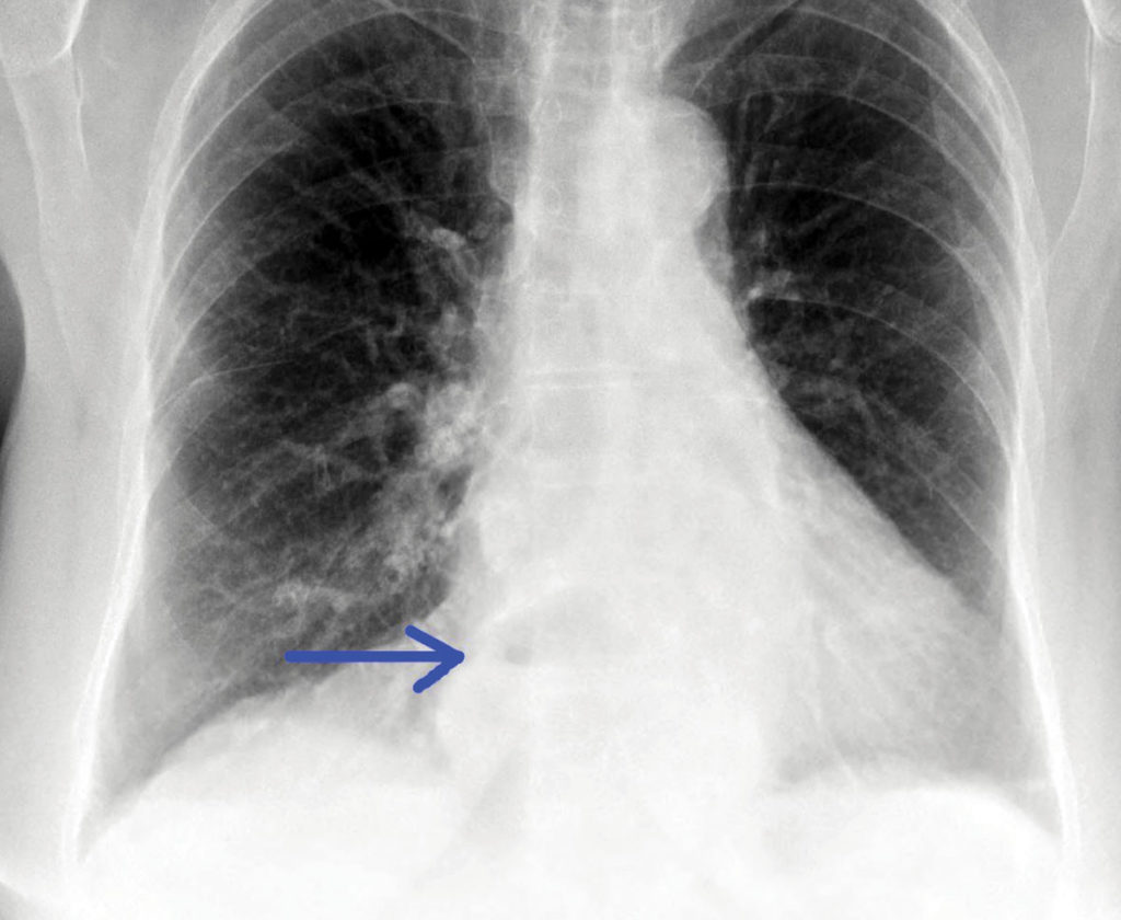 Clinical Update: Reflux-induced respiratory disease - Medical Forum