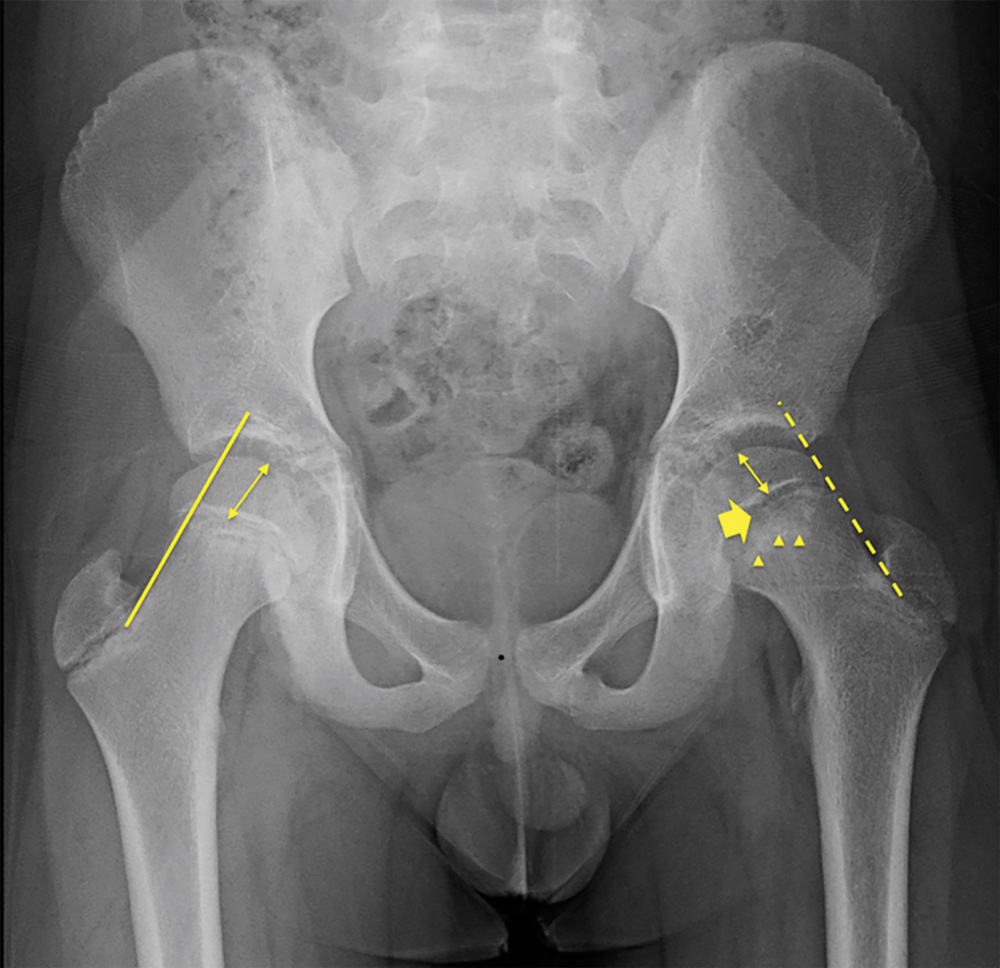 Imaging of slipped capital femoral epiphysis - Medical Forum