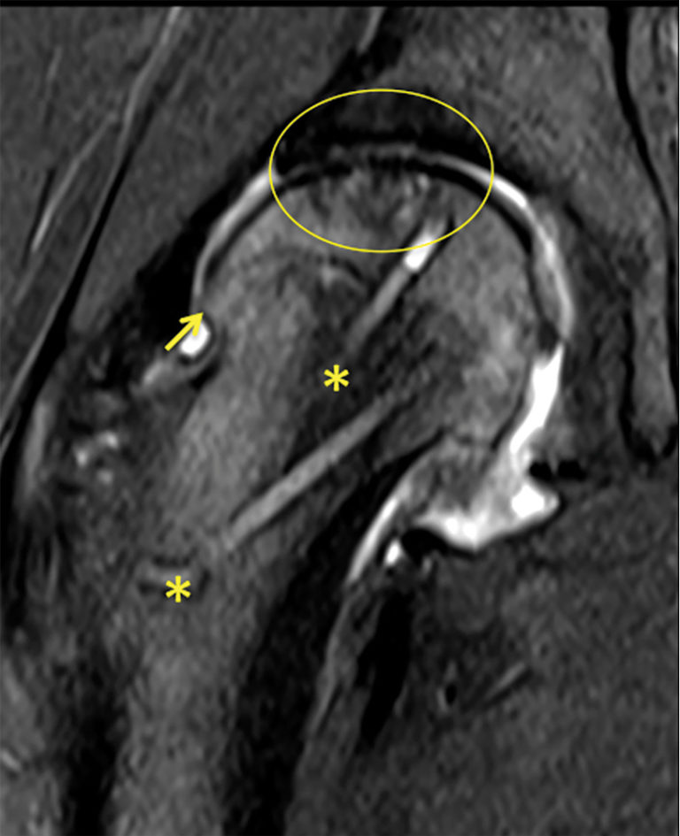 Imaging of slipped capital femoral epiphysis - Medical Forum