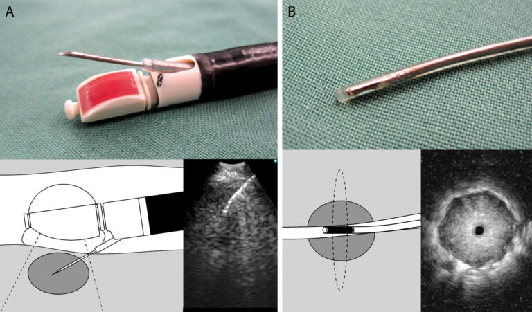 Endobronchial ultrasound - Medical Forum
