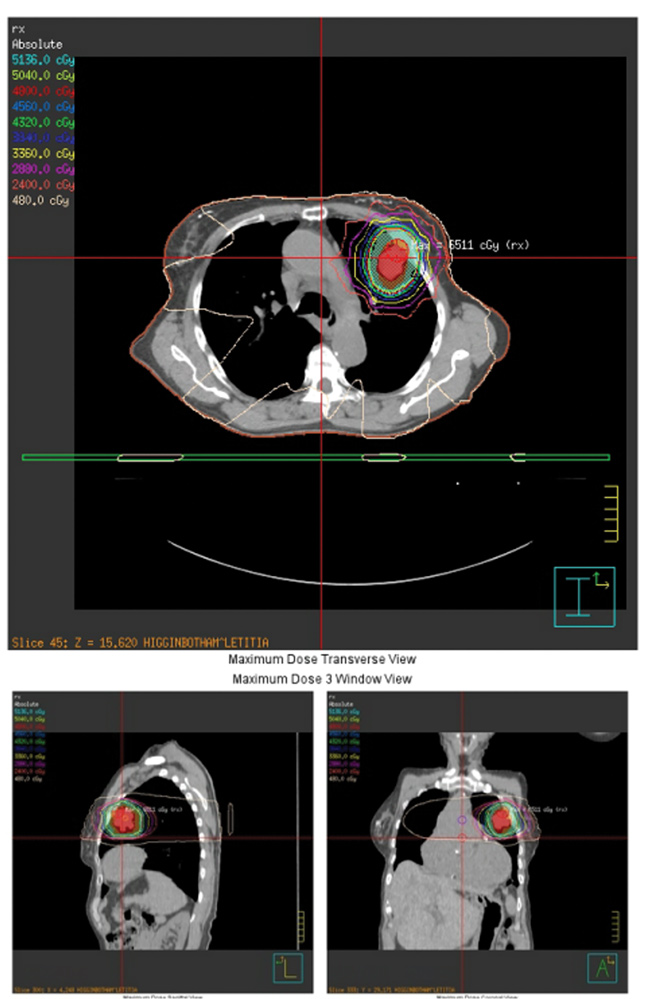 Treating lung cancer with stereotactic ablative body radiation therapy ...