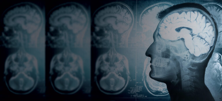 Brain-scan-head - Medical Forum