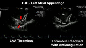 LAA-Thrombus-and-LAA-Occlusion-1 - Medical Forum