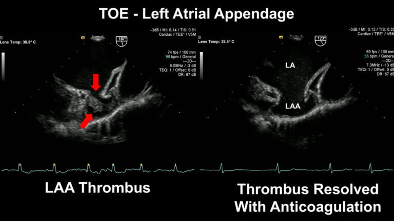Left Atrial appendage occlusion (LAAO) in atrial fibrillation - Medical ...