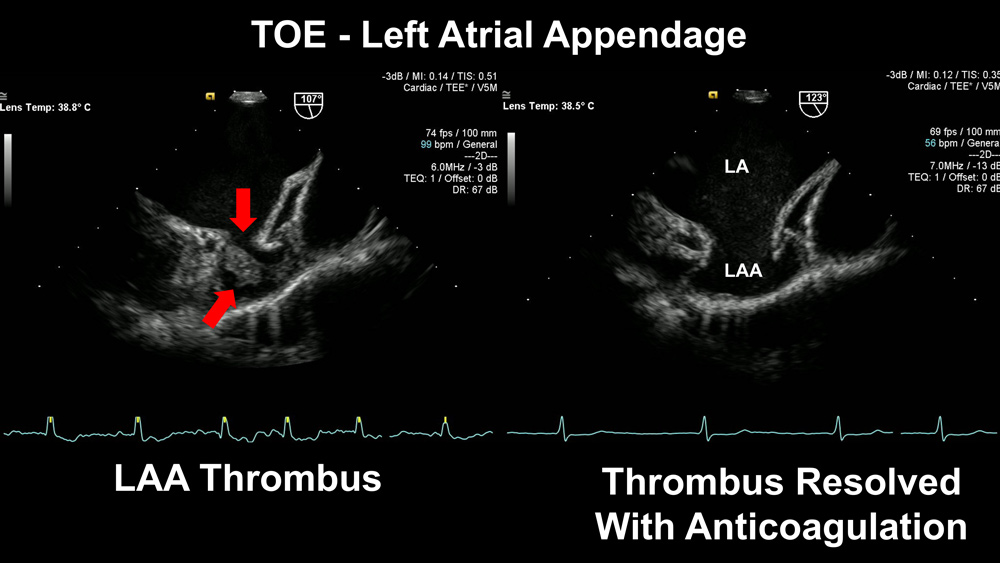 Left Atrial appendage occlusion (LAAO) in atrial fibrillation - Medical ...