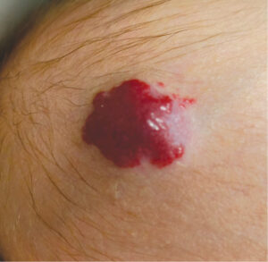 Figure-1-birthmark - Medical Forum