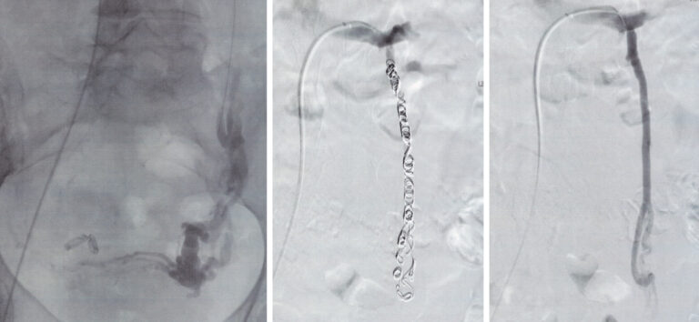 Pelvic venous congestion - Medical Forum