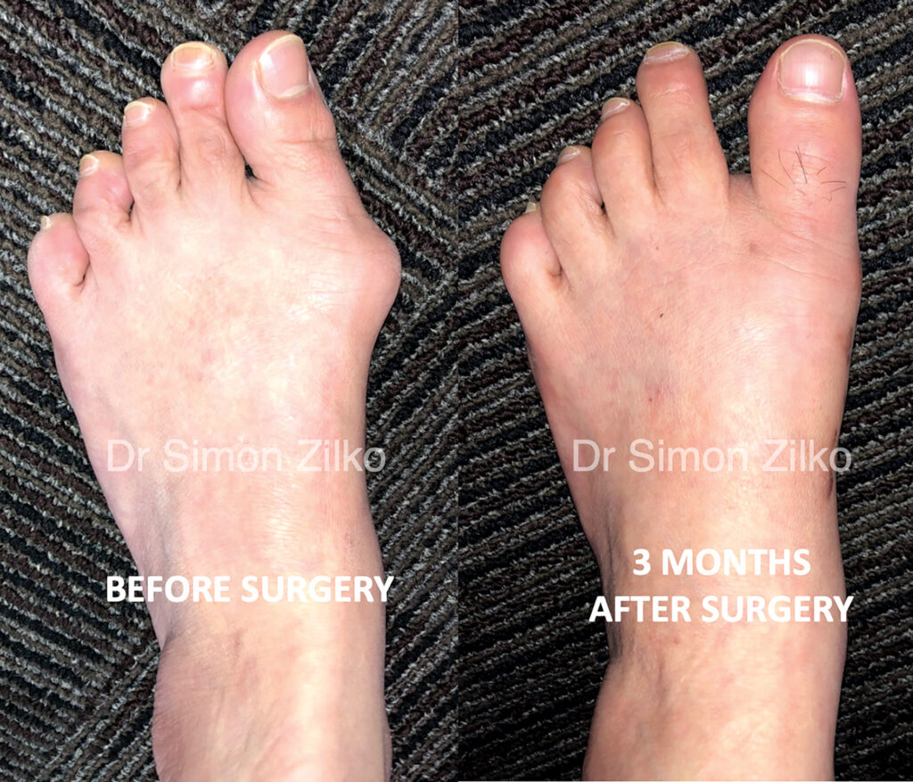 New frontiers in foot surgery and total ankle replacement - Medical Forum