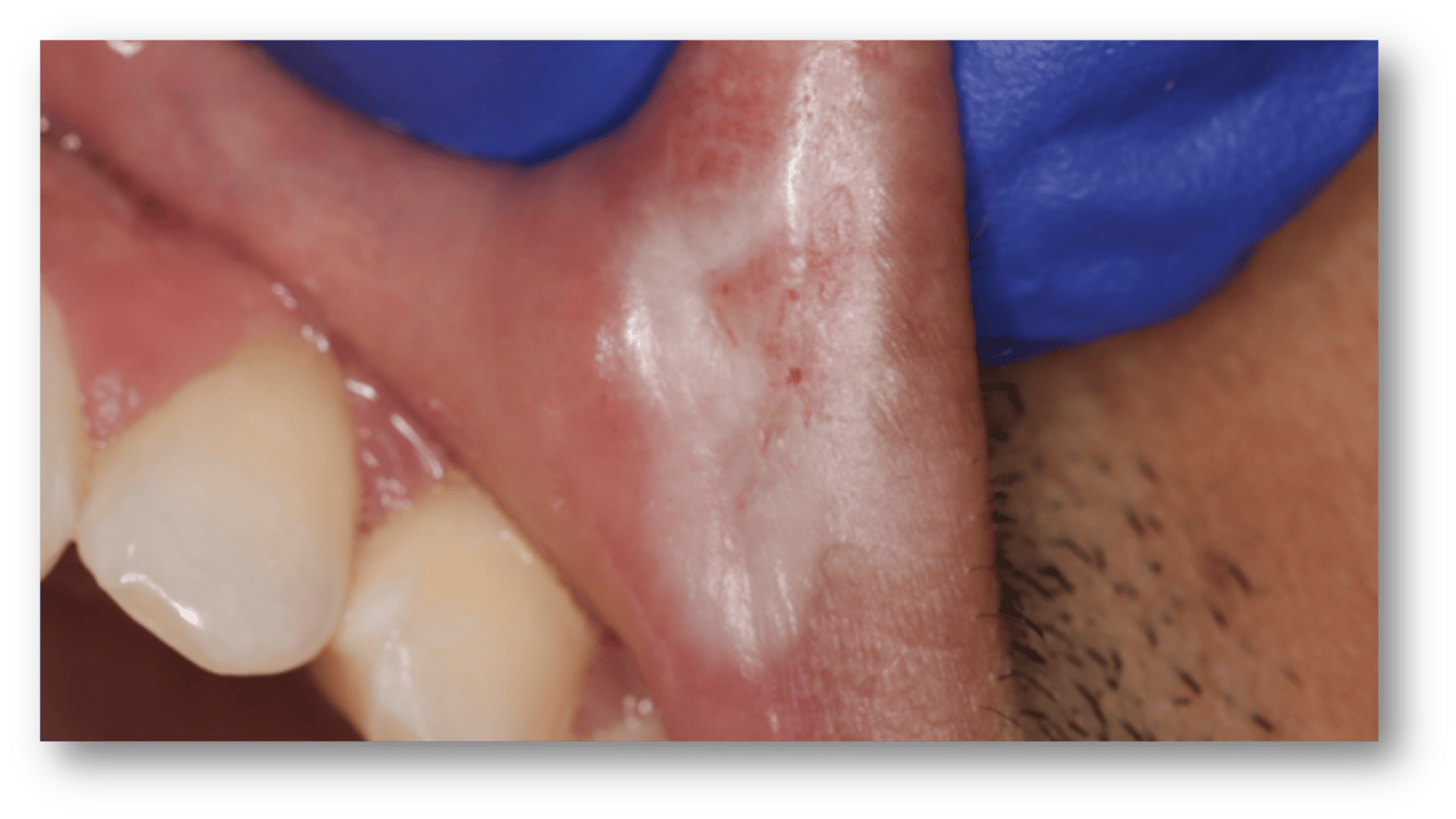 Clinical quiz: White lesion on the upper labial mucosa