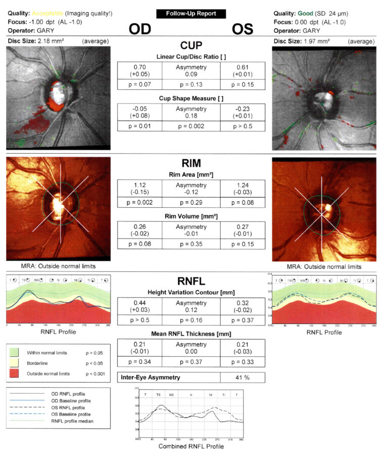 Glaucoma update - Medical Forum