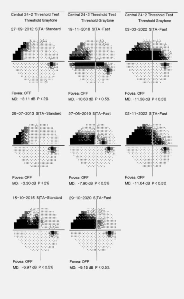Glaucoma update - Medical Forum