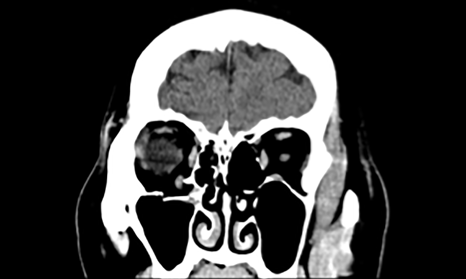 Clinical quiz: Binocular horizontal and vertical diplopia