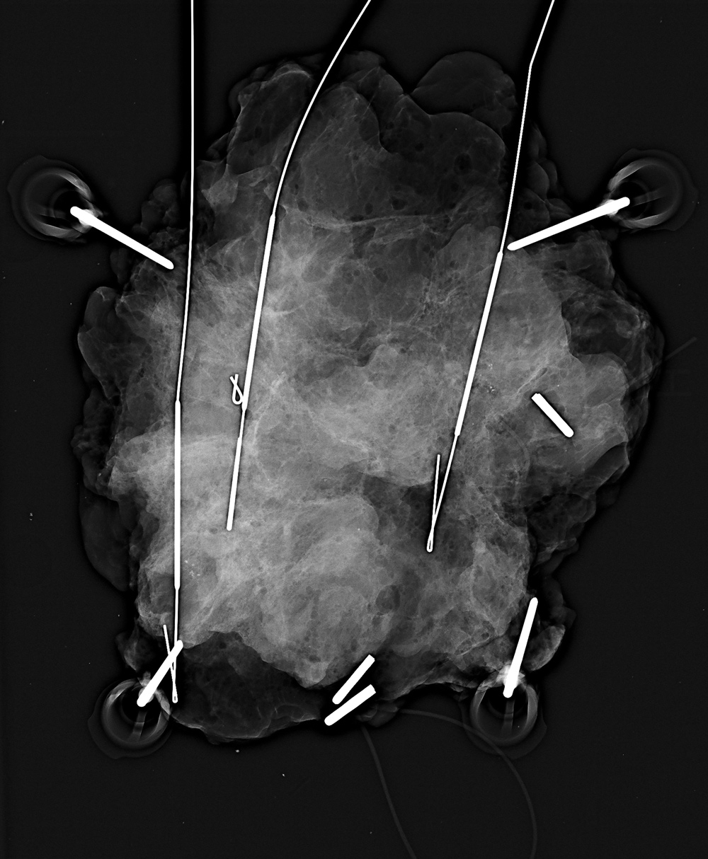 Fig.-1b-Specimen-xray-of-the-resected-area-with-all-3-hookwires ...