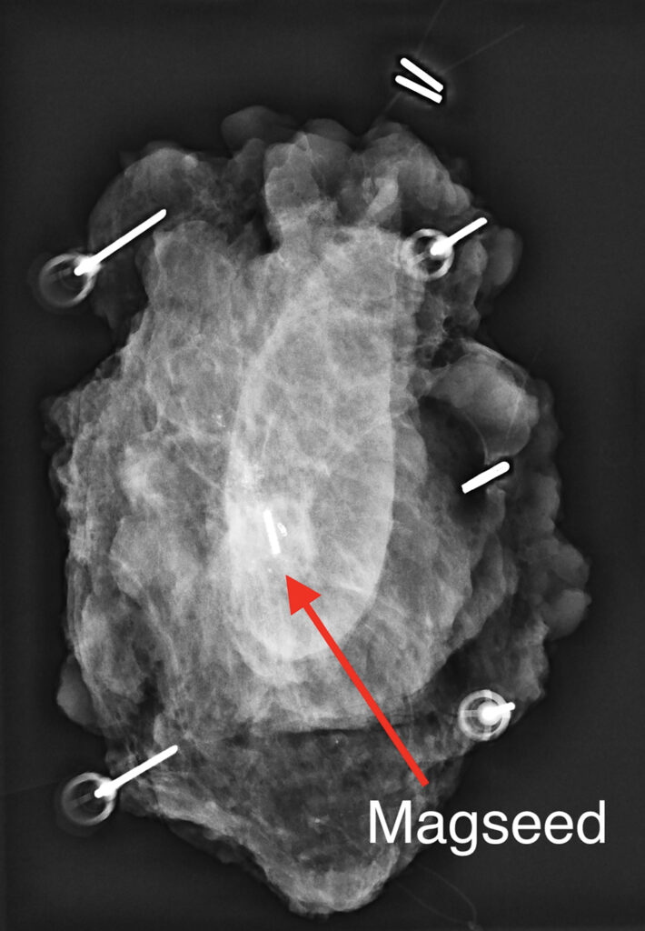 Fig.-4-Specimen-xray-with-Magseed-in-the-centre. - Medical Forum