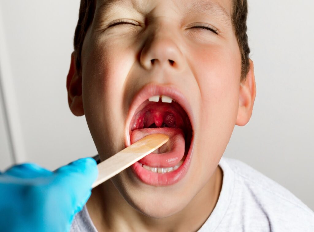 Strep A’s southern surge - Medical Forum