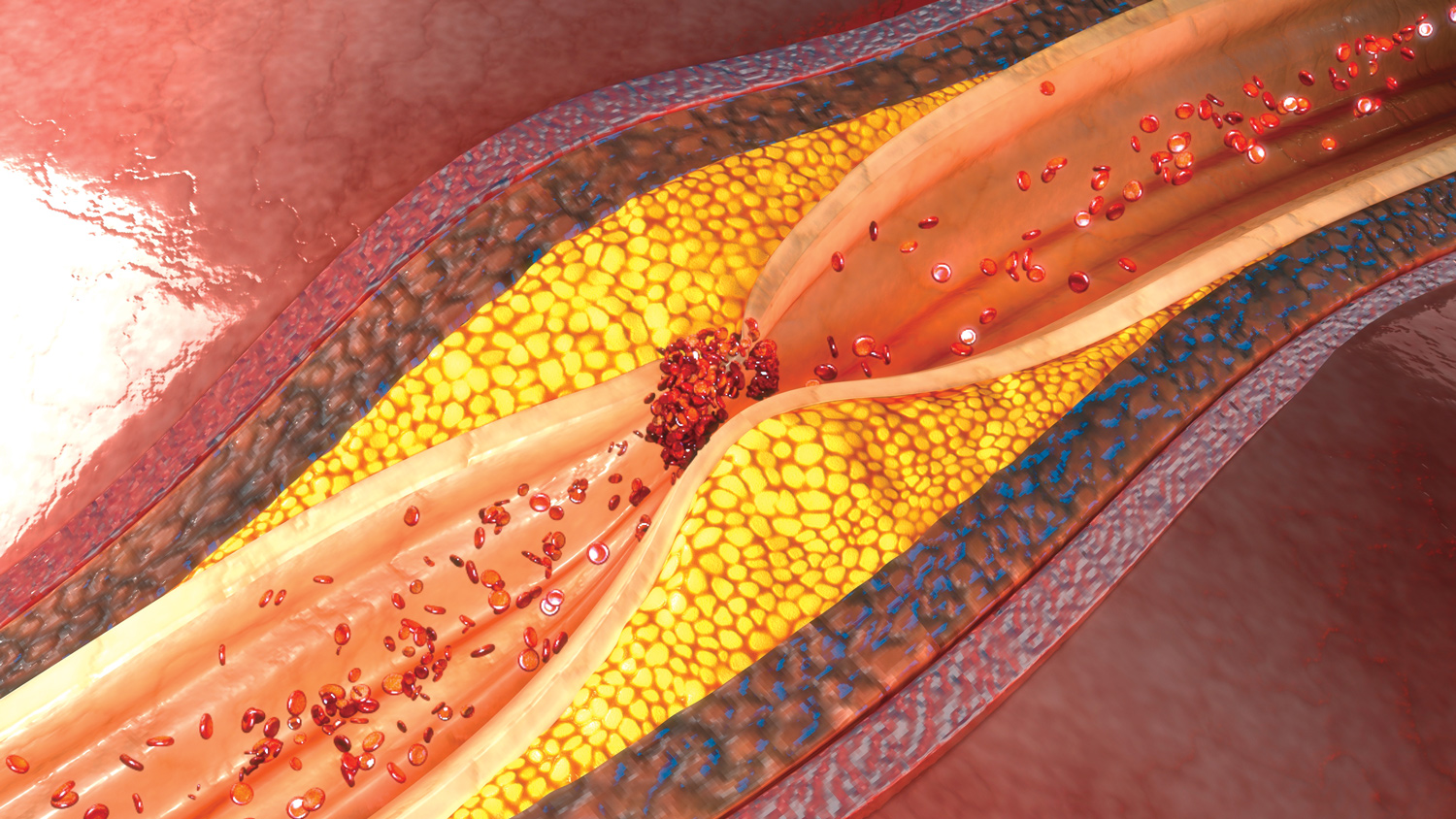 Coronary-artery-plaque - Medical Forum