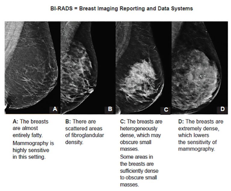 Mammographic Breast Density Medical Forum