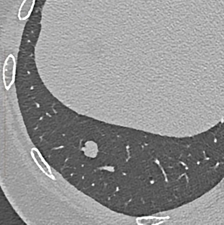 Lung nodules – navigating the incoming cases - Medical Forum