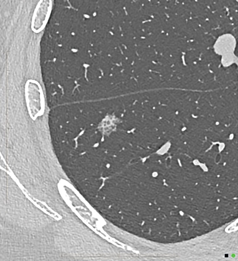 Lung nodules – navigating the incoming cases - Medical Forum