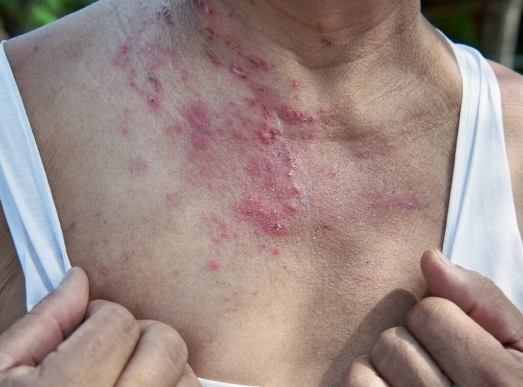 More Aussies eligible for shingles vaccine - Medical Forum