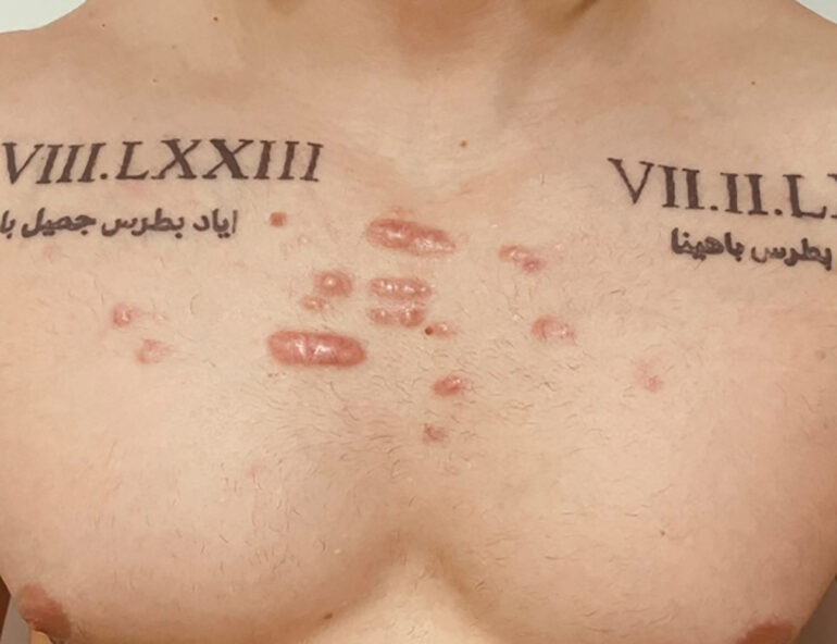 Fig-1-Pre-laser-keloid-chest - Medical Forum