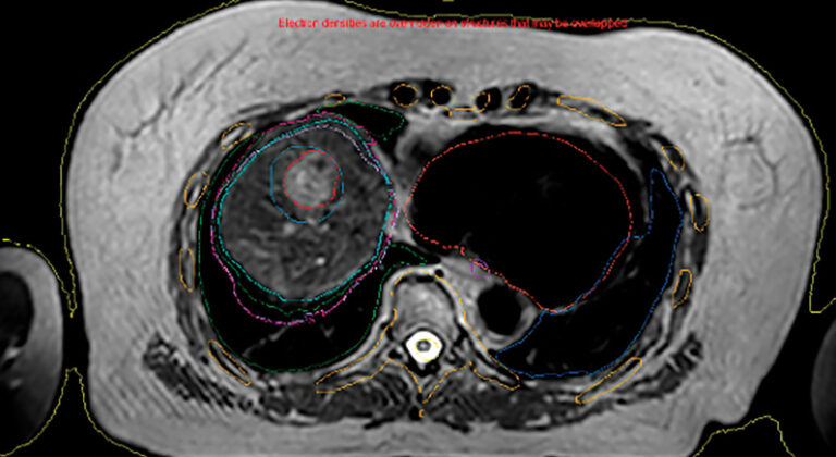 Precision radiation therapy with MRI Linear Accelerator (MR Linac ...