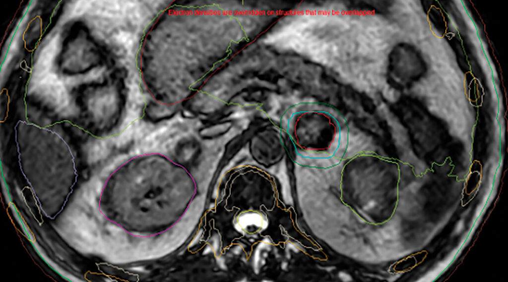 Precision radiation therapy with MRI Linear Accelerator (MR Linac ...