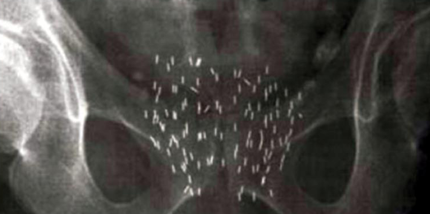 Targeted prostate cancer treatment at Hollywood Hospital