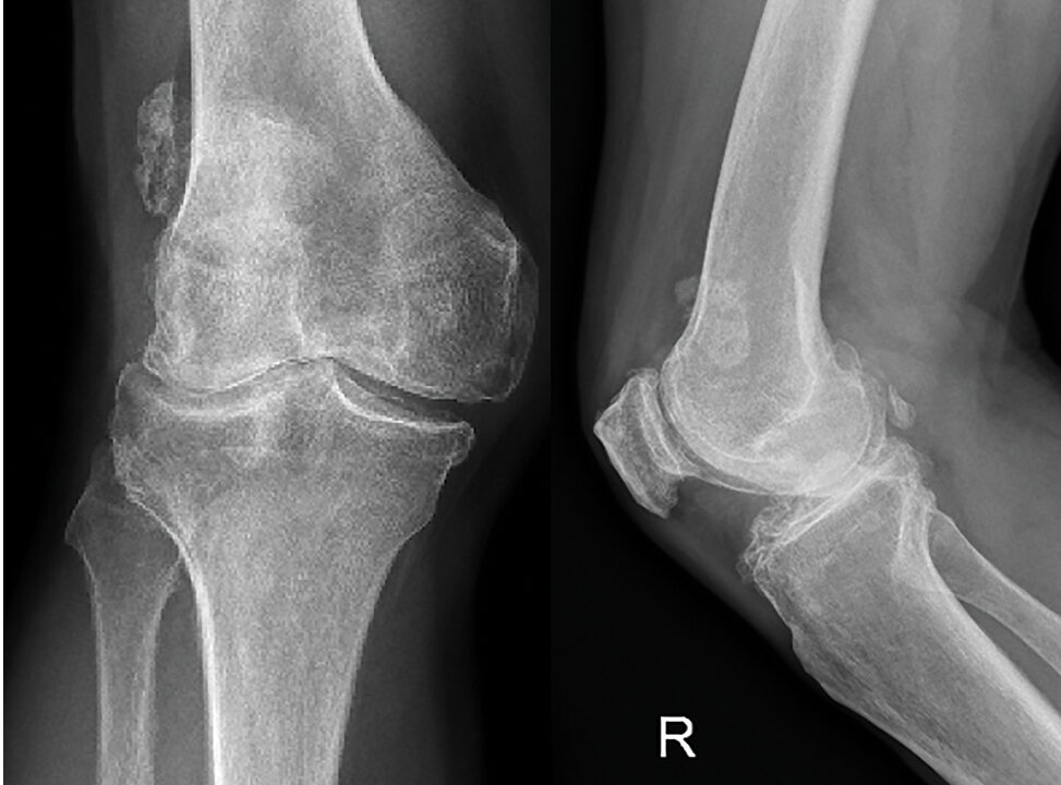 A GP’s guide to hip and knee arthritis