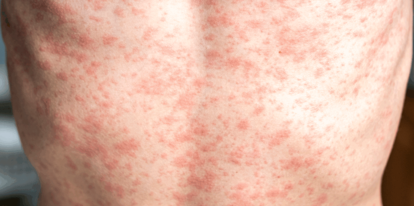 Two Locally Acquired Measles Cases Reported in WA