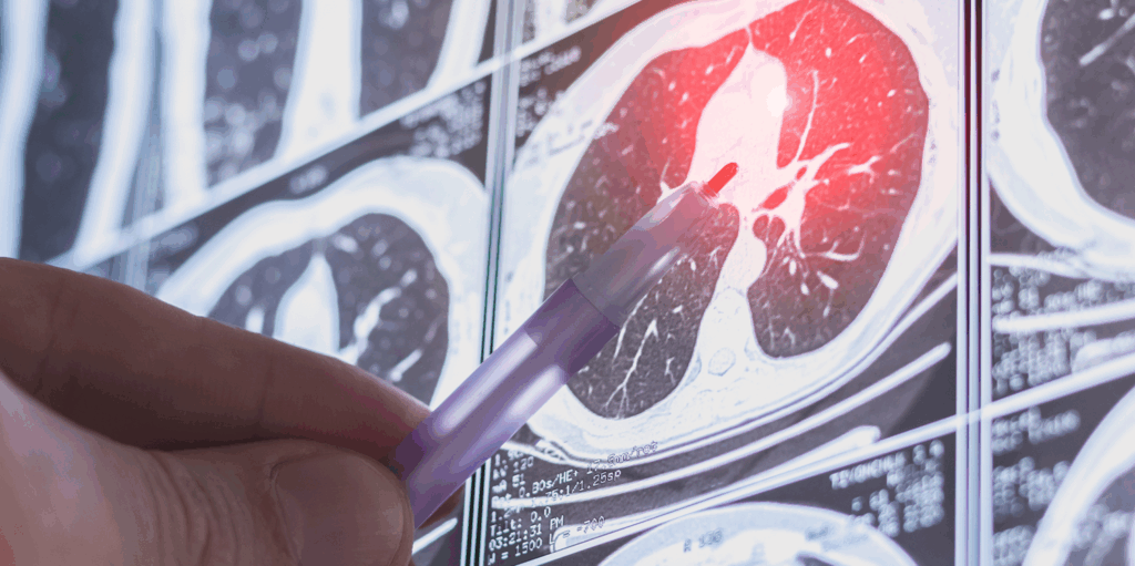 National Lung Cancer Screening Program – what you need to know