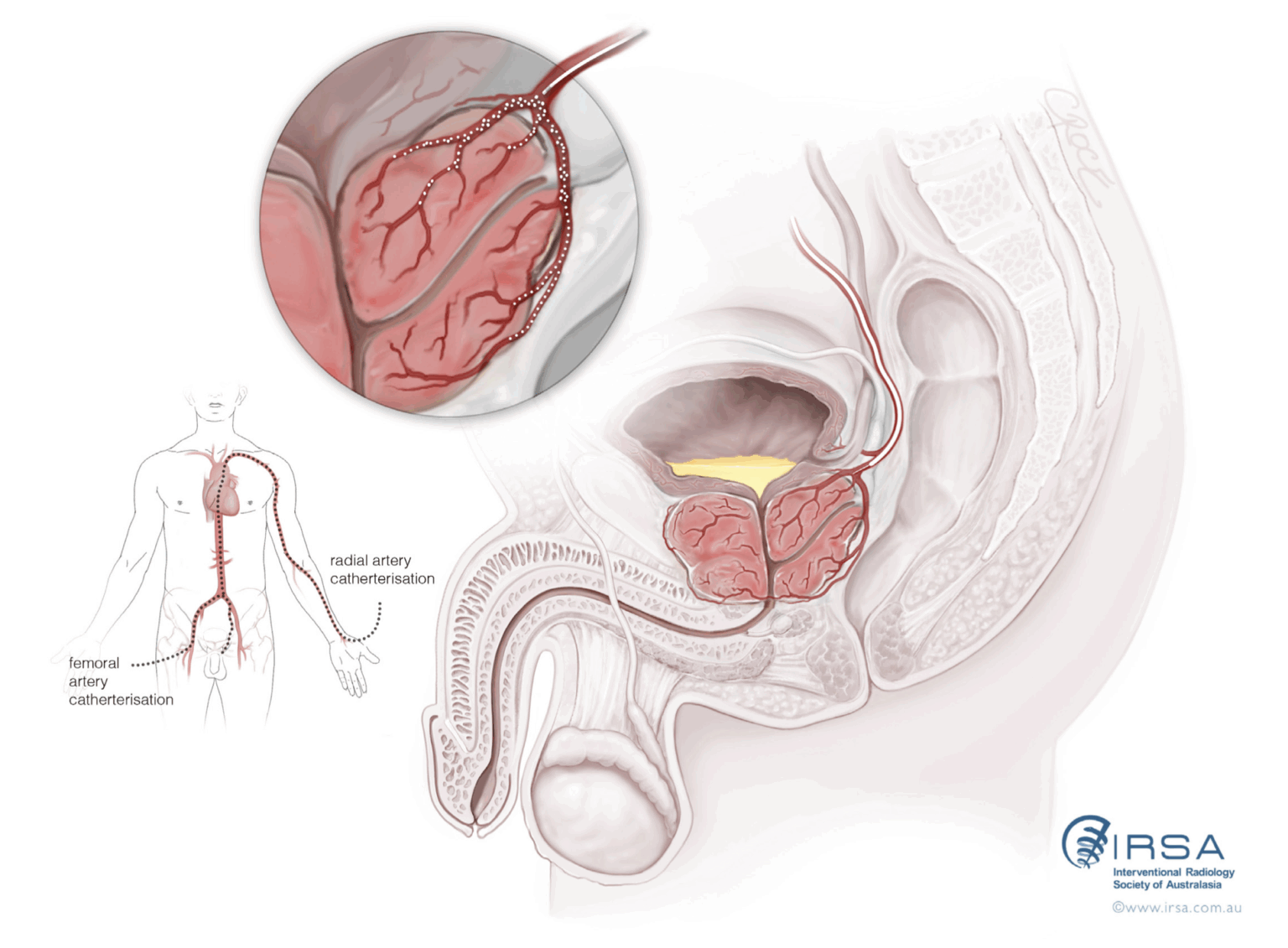 Prostate artery embolisation - the verdict is in