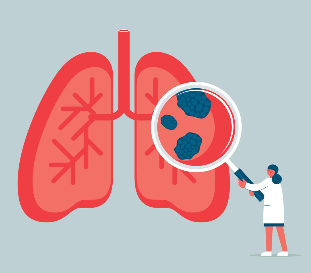 Thousands screened in first six months of lung cancer screening program