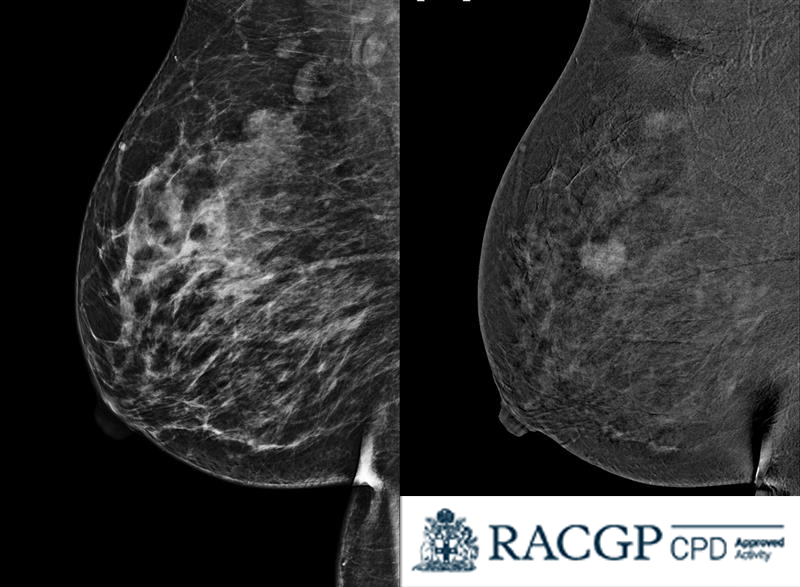 Contrast-enhanced mammograms: A guide for GPs