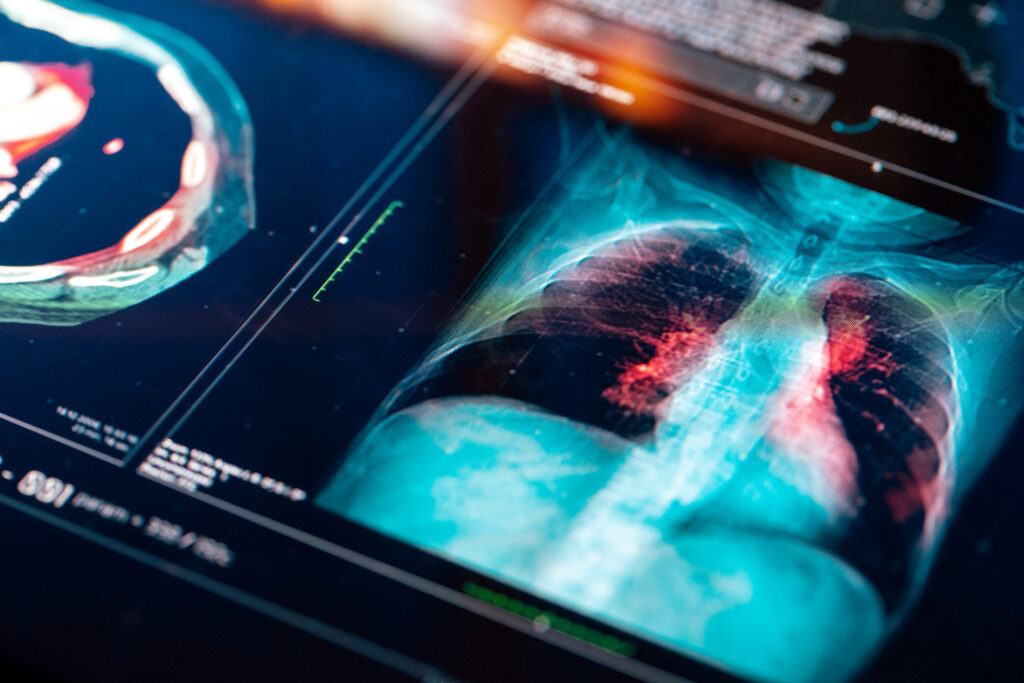 One year on: National lung screening program having an impact